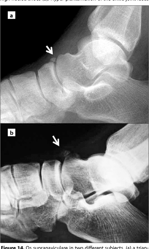 Figure 1 from The Accessory Ossicles of the Foot and Ankle; a ...