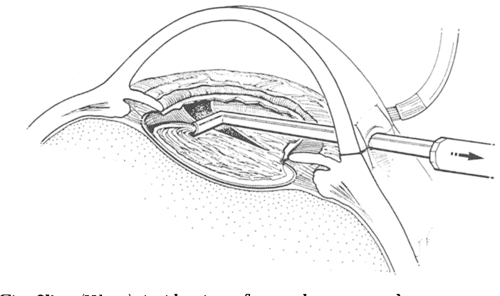 Figure 2 from Management of a posterior capsule rupture in planned ...