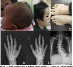 Table 1 from Greig cephalopolysyndactyly syndrome caused by novel GLI3 ...