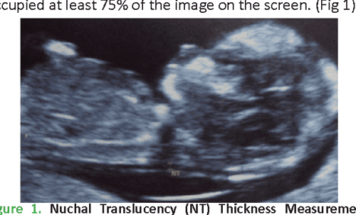 Nuchal translucency in normal fetus and its variation with increasing ...