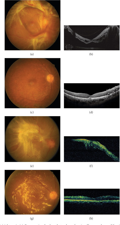 Figure 1 from Combined Tractional and Rhegmatogenous Retinal Detachment ...
