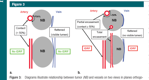 Guidelines for imaging and staging of neuroblastic tumors: consensus ...