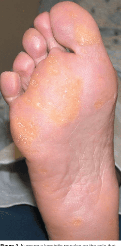 [PDF] Keratosis punctata palmoplantaris controlled with topical ...
