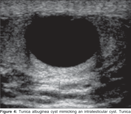 [PDF] Sonographic Spectrum of Tunica Albuginea Cyst | Semantic Scholar