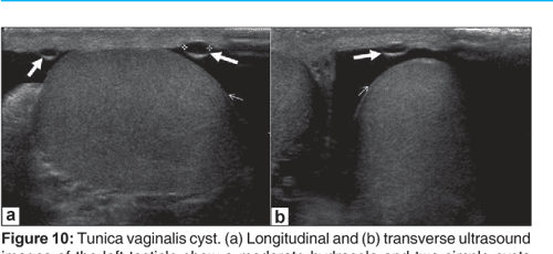 Figure 6 from Sonographic Spectrum of Tunica Albuginea Cyst | Semantic ...