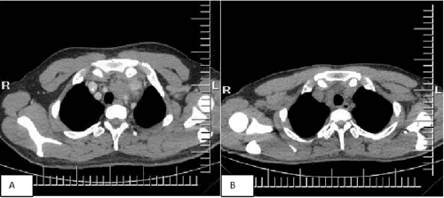 Acute Epstein–Barr virus positive cytotoxic T/Nature Killer cell ...