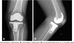 Figure 3 from Ultrasonographic Diagnosis of the Patellar Clunk Syndrome ...