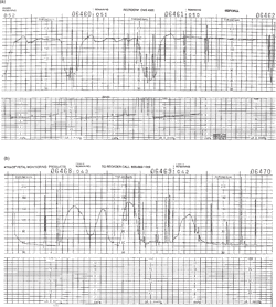 Figure 2 from Title Sinusoidal heart rate pattern : Reappraisal of its ...