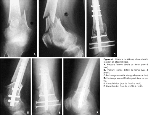 Figure 4 from Fracture de la diaphyse fémorale de l'adulte | Semantic ...