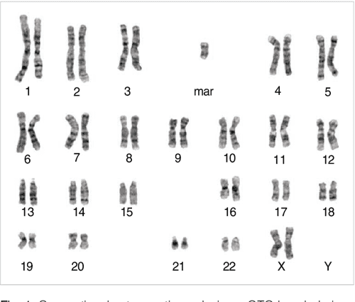 Figure 1 from Prenatal diagnosis of Pallister-Killian syndrome ...