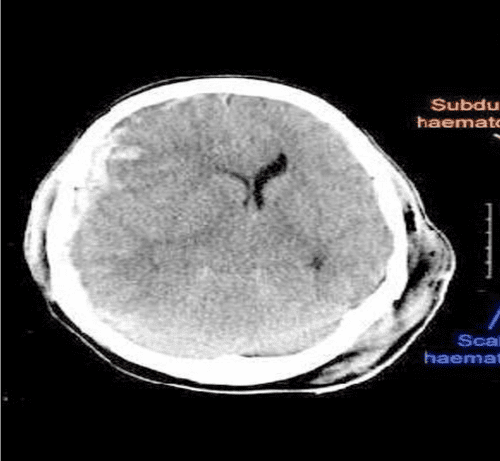 Figure 1 from Measurement of Normal Brain Lateral Ventricles byUsing CT ...
