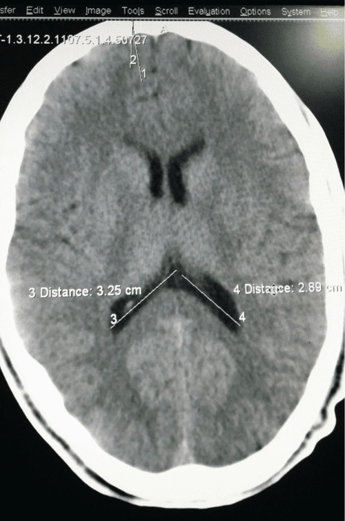 Figure 1 from Measurement of Normal Brain Lateral Ventricles byUsing CT ...