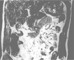 Clinical involvement of mesenteric and antimesenteric borders of small ...