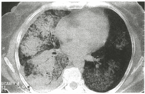 [PDF] CT features of bronchiolo-alveolar carcinoma | Semantic Scholar