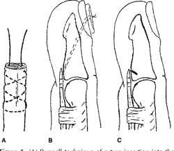 Figure 1 from Cyclic testing of pullout sutures and micro-mitek suture ...