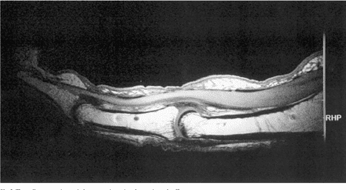Figure 1 from Mri ‘Magic Angle’ Imaging of Finger Tendons | Semantic ...