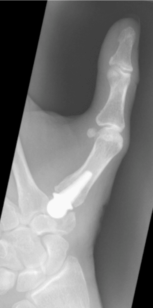 Figure 2 from Implant Arthroplasty for Proximal Interphalangeal ...