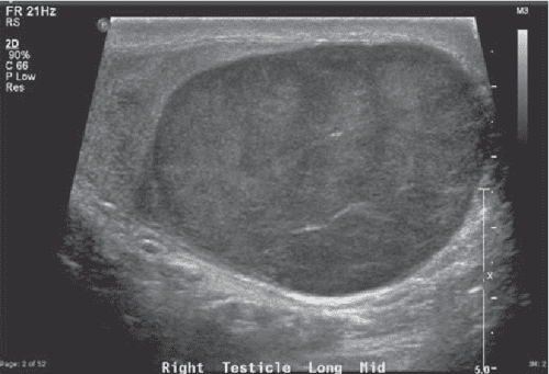 Testicular Tumor Ultrasound Characteristics and Association with ...