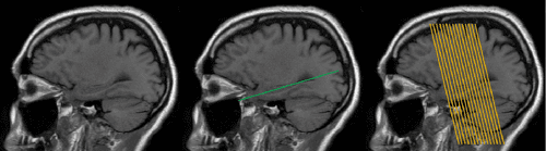 Limbic system in MRI: what the radiologist needs to know | Semantic Scholar
