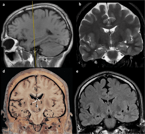 Limbic system in MRI: what the radiologist needs to know | Semantic Scholar