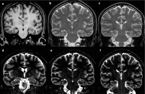 Limbic system in MRI: what the radiologist needs to know | Semantic Scholar