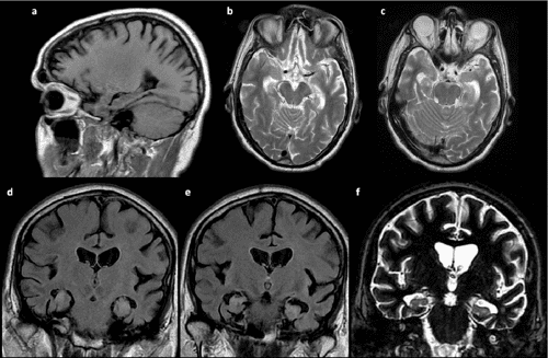 Limbic system in MRI: what the radiologist needs to know | Semantic Scholar