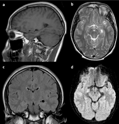 Limbic system in MRI: what the radiologist needs to know | Semantic Scholar