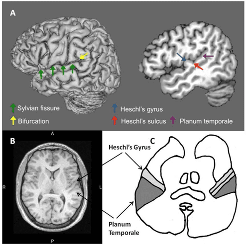 Figure 3 from Planum temporale asymmetry in people who stutter ...