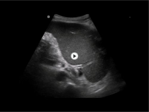 Figure 2 from Imaging appearance of Gamna Gandy bodies | Semantic Scholar