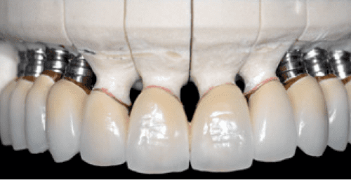 [PDF] Biologically oriented preparation technique (BOPT): a new ...