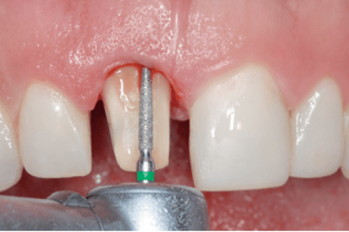 [PDF] Biologically oriented preparation technique (BOPT): a new ...