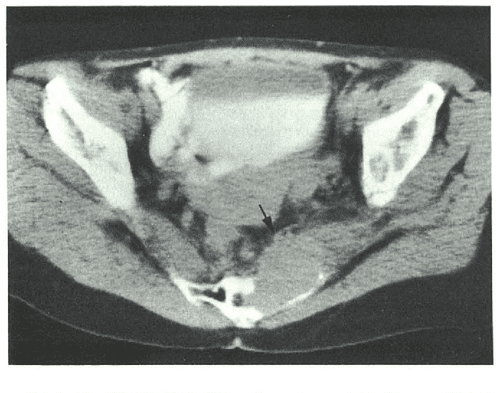 Figure 2 From Ct Evaluation Of The Greater Sciatic Foramen In Patients With Sciatica Semantic