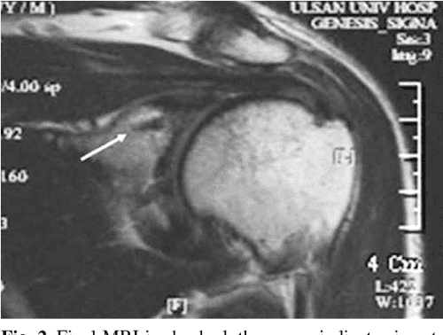 Table 1 from Arthroscopic Repair of Type II SLAP Lesion with ...