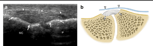 Ultrasound of displaced ulnar collateral ligament tears of the thumb ...