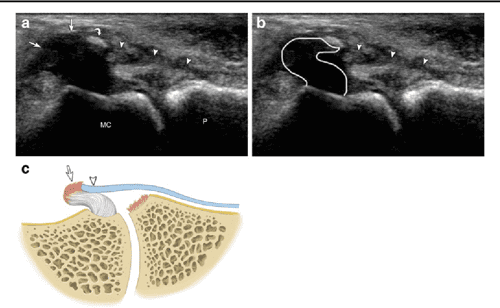 Ultrasound of displaced ulnar collateral ligament tears of the thumb ...