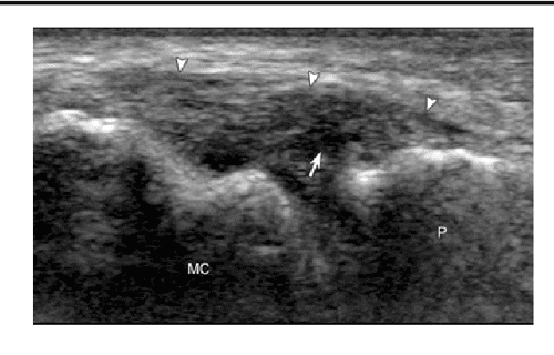 Ultrasound of displaced ulnar collateral ligament tears of the thumb ...