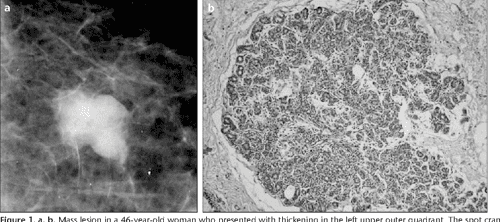 Figure 3 from Sclerosing adenosis of the breast: radiologic appearance ...