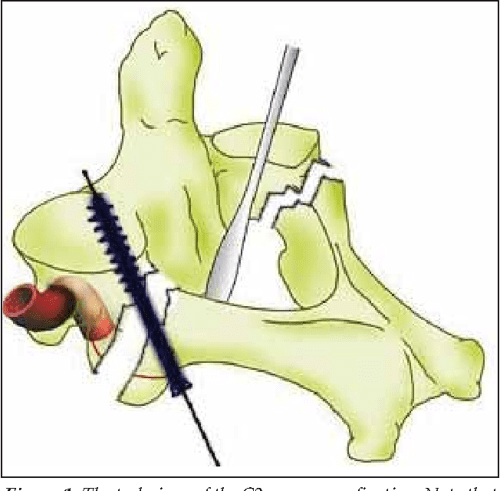 Traumatic spondylolisthesis of the axis treated with direct C2 pars ...