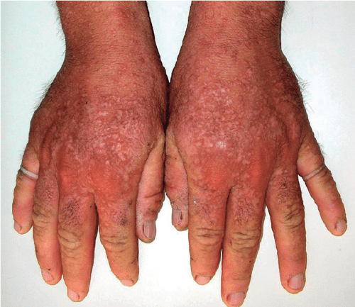 Figure 2 from Enfermedad de Darier y acroqueratosis verruciforme de ...