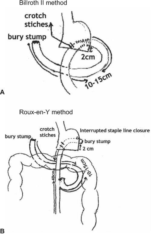 Figure 2 from Roux-enY or Billroth II Reconstruction After Radical ...