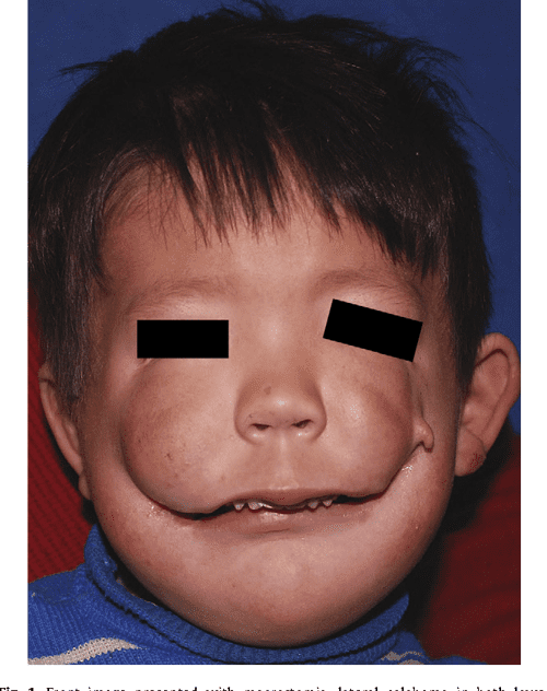 Figure 1 from A rare bilateral Tessier no. 6 and 7 clefts. | Semantic ...