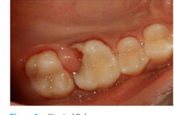 Figure 1 from Management of Gingival Polyp in Restoration Procedure: A ...