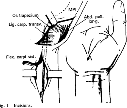 Ligament Reconstruction of the Thumb Carpometacarpal Joint using a ...