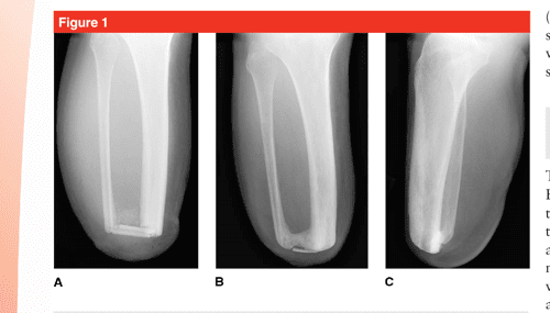 Osteomyoplastic Transtibial Amputation: The Ertl Technique | Semantic ...