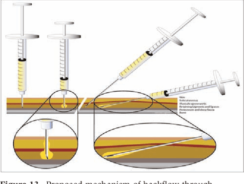 Figure 2 from Cannula Versus Sharp Needle for Placement of Soft Tissue ...