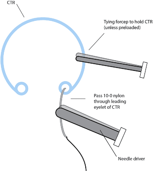 Table 1 from Suture-guided capsular tension ring insertion to reduce ...