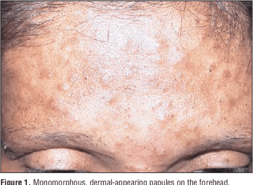 Figure 3 from Eosinophilic folliculitis in 2 HIV-positive women ...