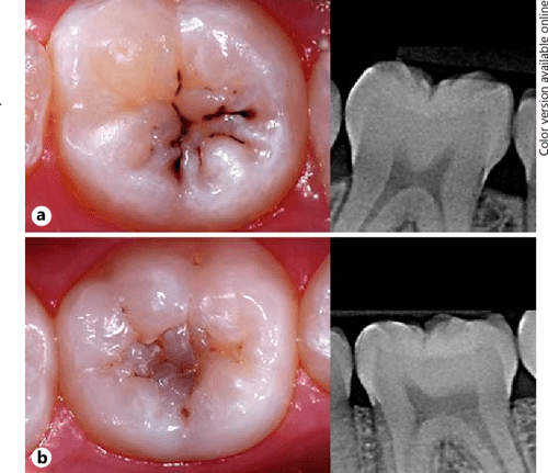 Clinical and Radiographic Diagnosis of Underlying Dark Shadow from ...