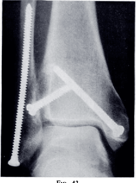 Figure 1 from The treatment of displaced fractures at the ankle by ...