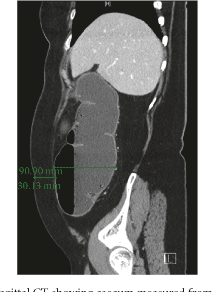 Figure 1 from Percutaneous Emergency Needle Caecostomy for Prevention ...